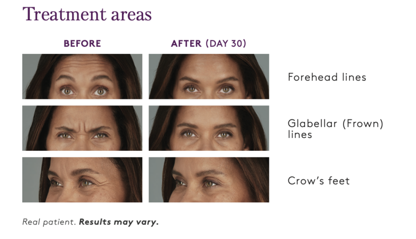 Botox Cosmetic – Precision Derma Clinic