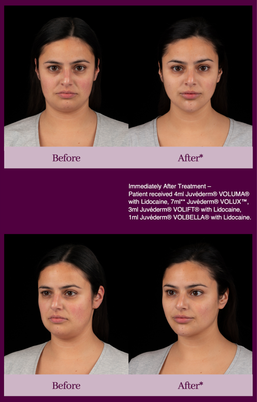 Hyaluronic Acid Fillers – Precision Derma Clinic